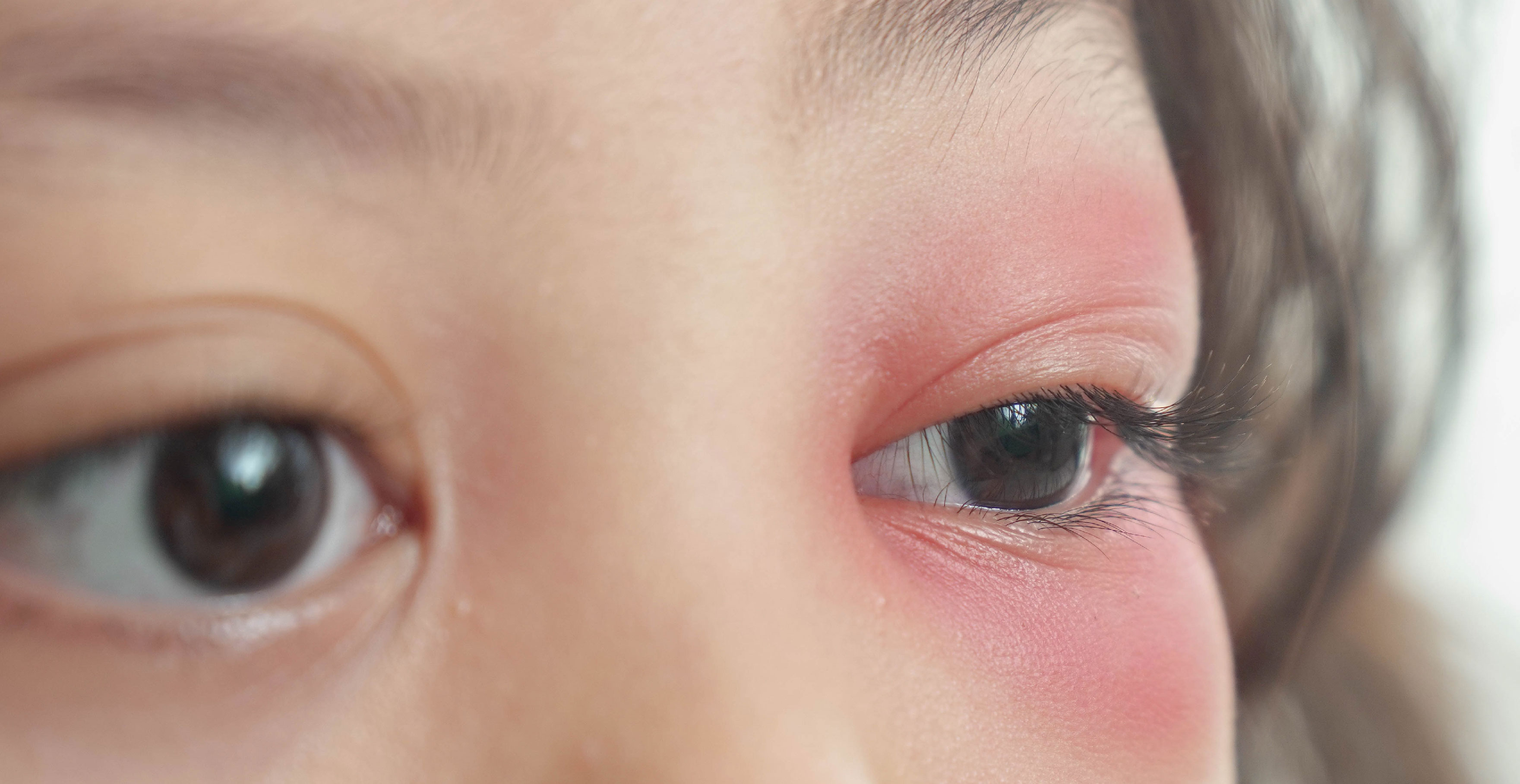 5 Penyebab Mata Bengkak dan Kenali Cara Mengatasinya